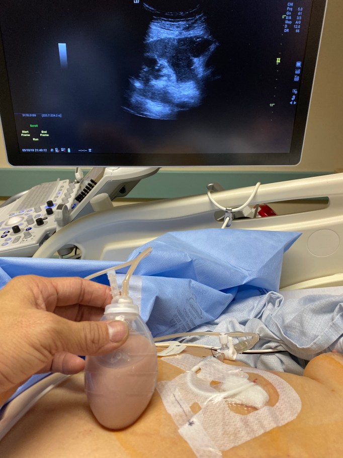 POCUS Skill: Bedside Percutaneous Cholecystostomy. #FOAMed, #FOAMcc ...